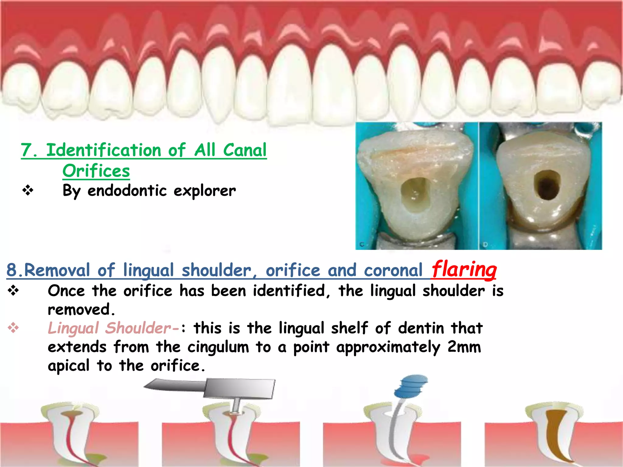 Access Cavity Preparation in : Maxillary Lateral Incisor | PPTX