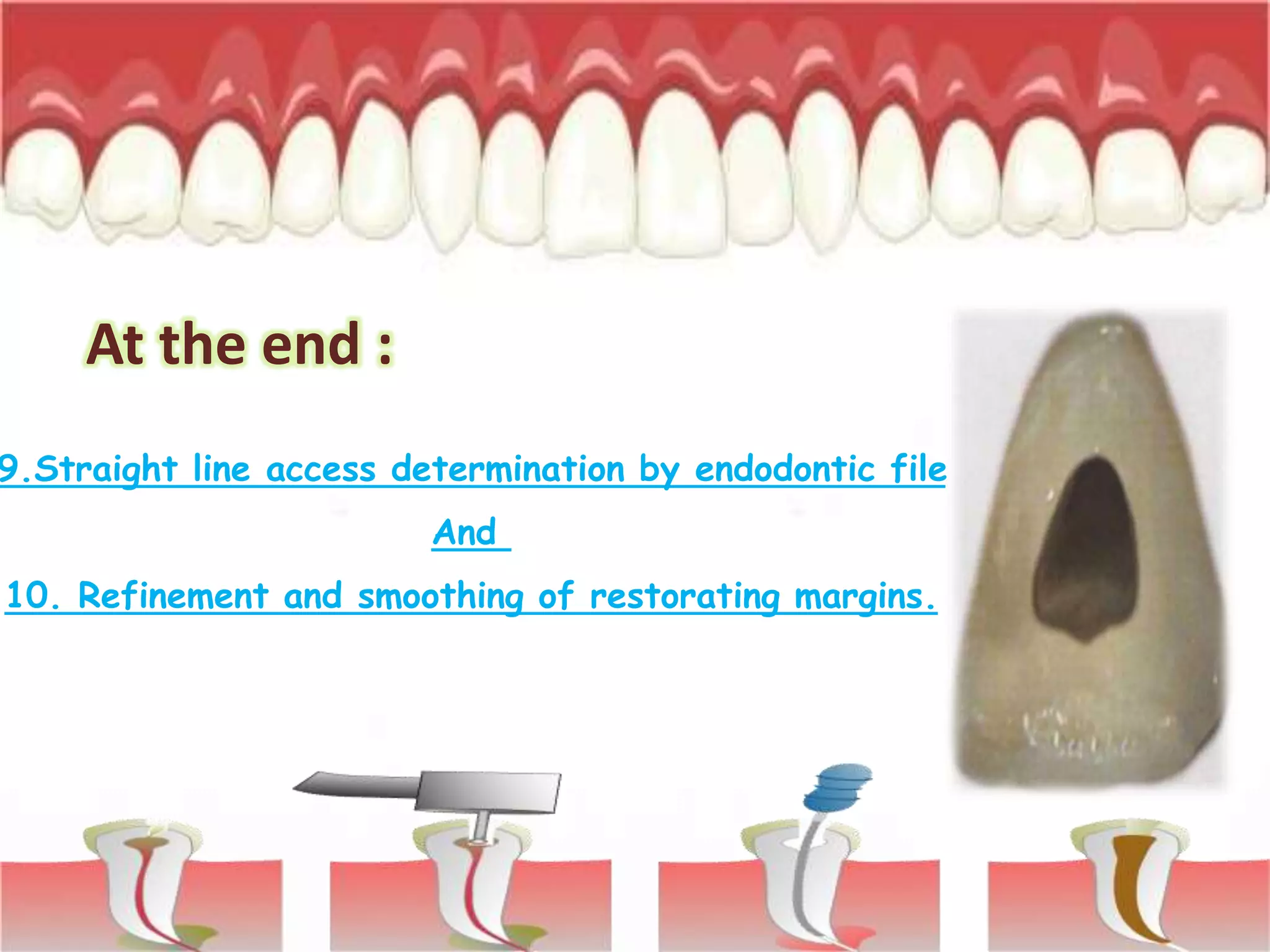 Access Cavity Preparation in : Maxillary Lateral Incisor | PPTX