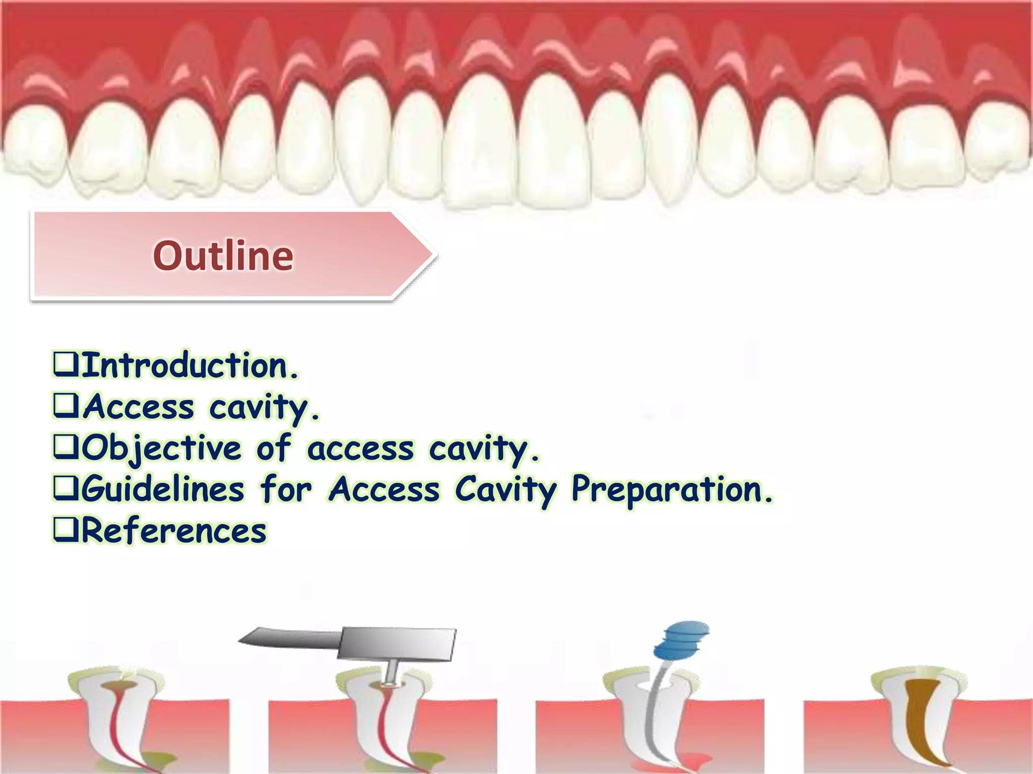 Access Cavity Preparation in : Maxillary Lateral Incisor | PPTX
