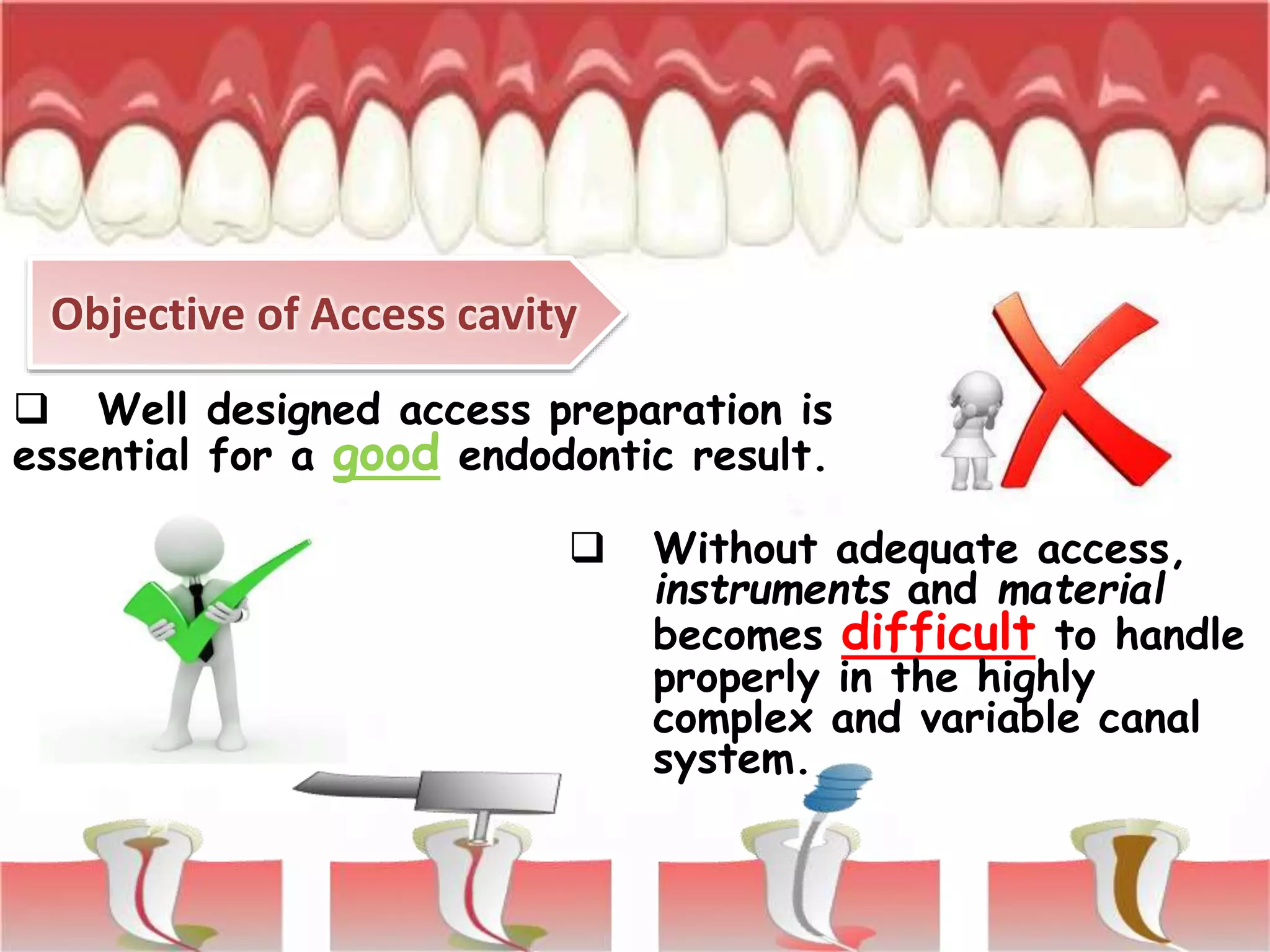 Access Cavity Preparation in : Maxillary Lateral Incisor | PPTX