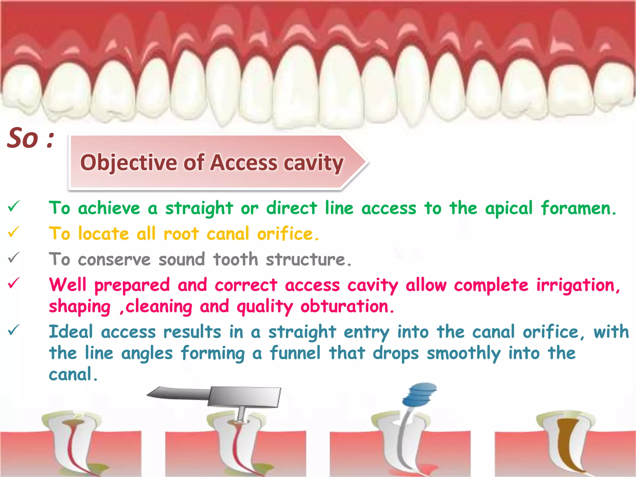 Access Cavity Preparation in : Maxillary Lateral Incisor | PPTX