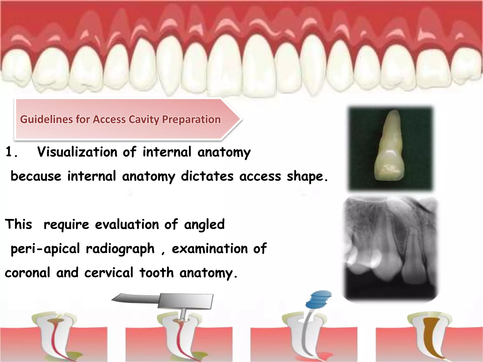 Access Cavity Preparation in : Maxillary Lateral Incisor | PPTX