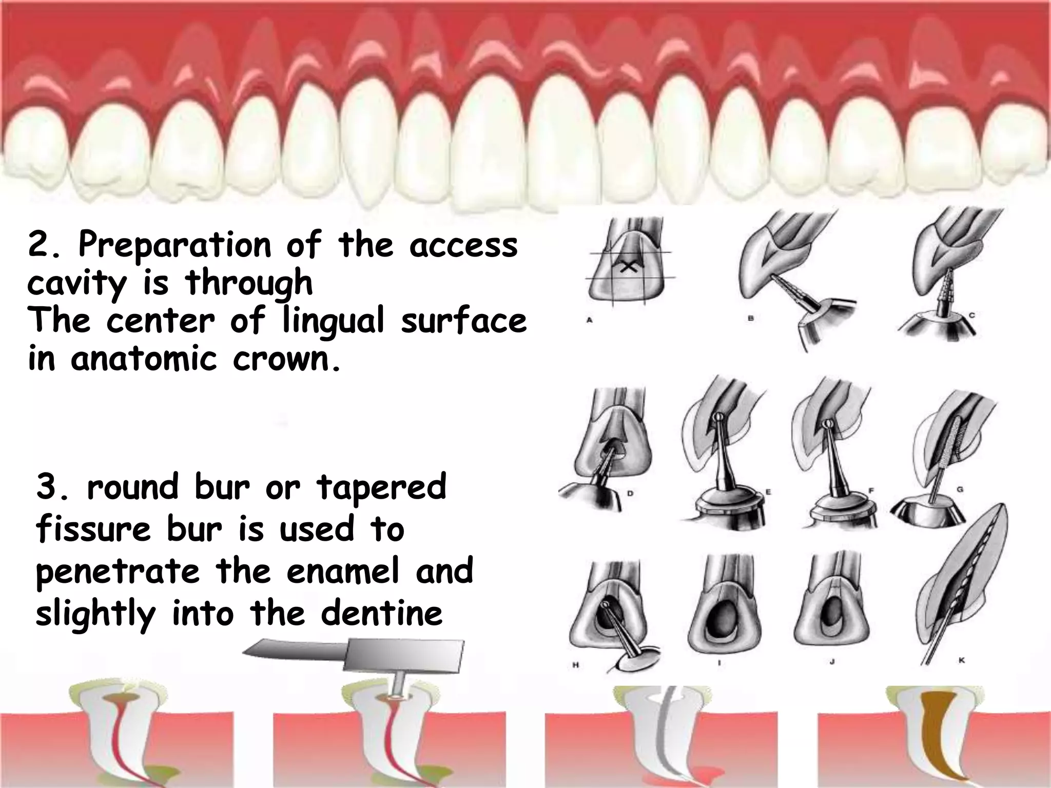 Access Cavity Preparation in : Maxillary Lateral Incisor | PPTX