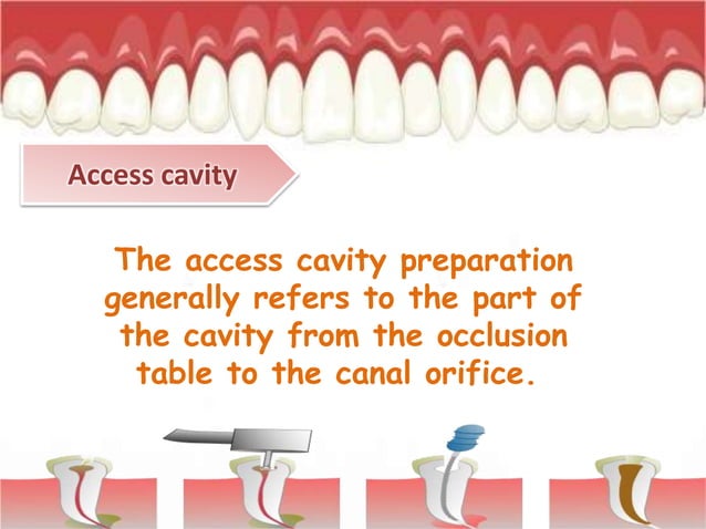 Access Cavity Preparation in : Maxillary Lateral Incisor | PPTX