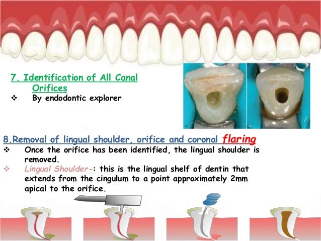 Access Cavity Preparation in : Maxillary Lateral Incisor