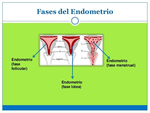 Endometriosis (UP)
