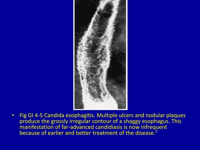 4 esophageal ulceration | PPTX | Digestive Disorders | Diseases and ...