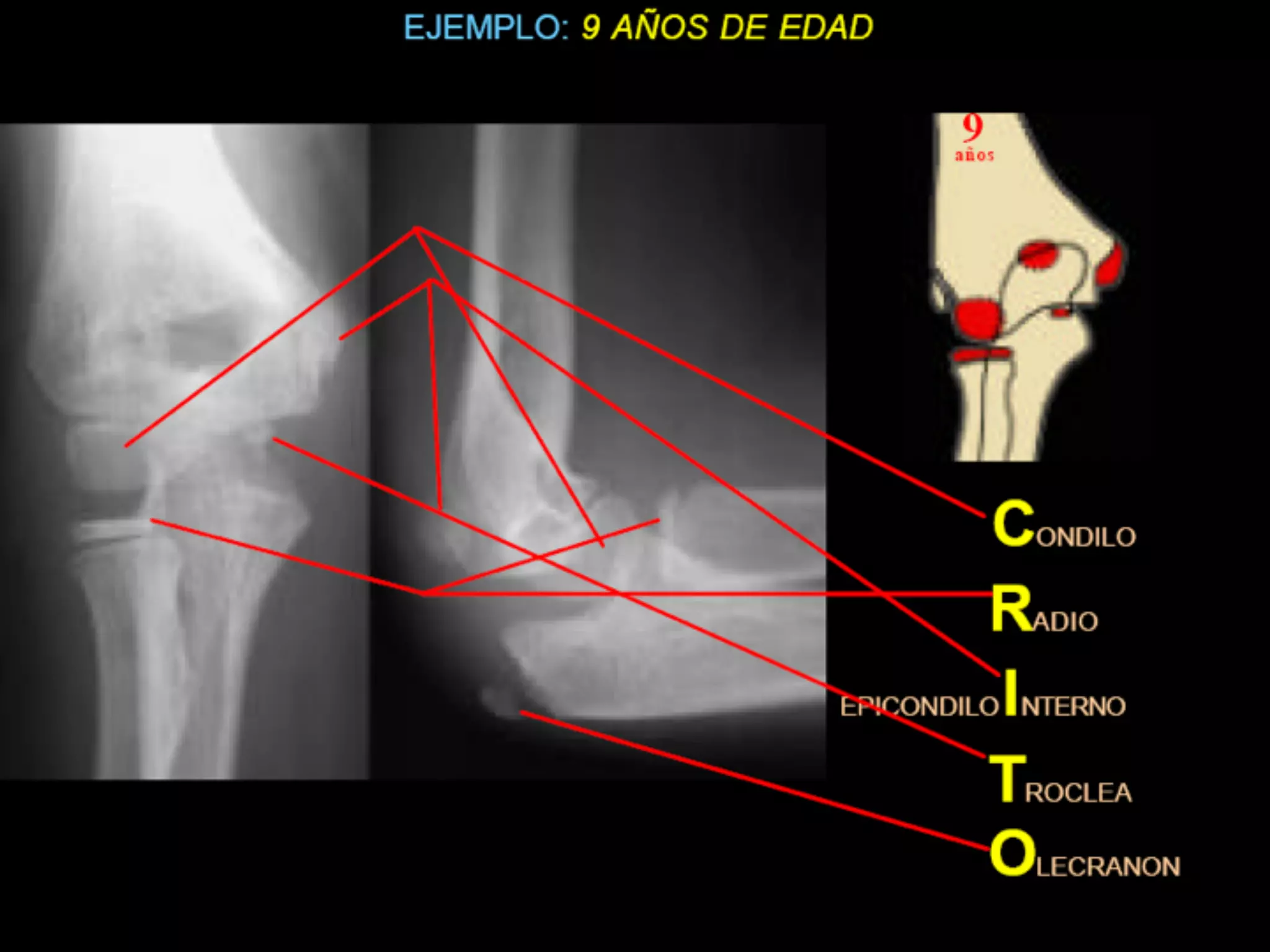 4 fx humero distal niños Dr Miguel Mite | PDF