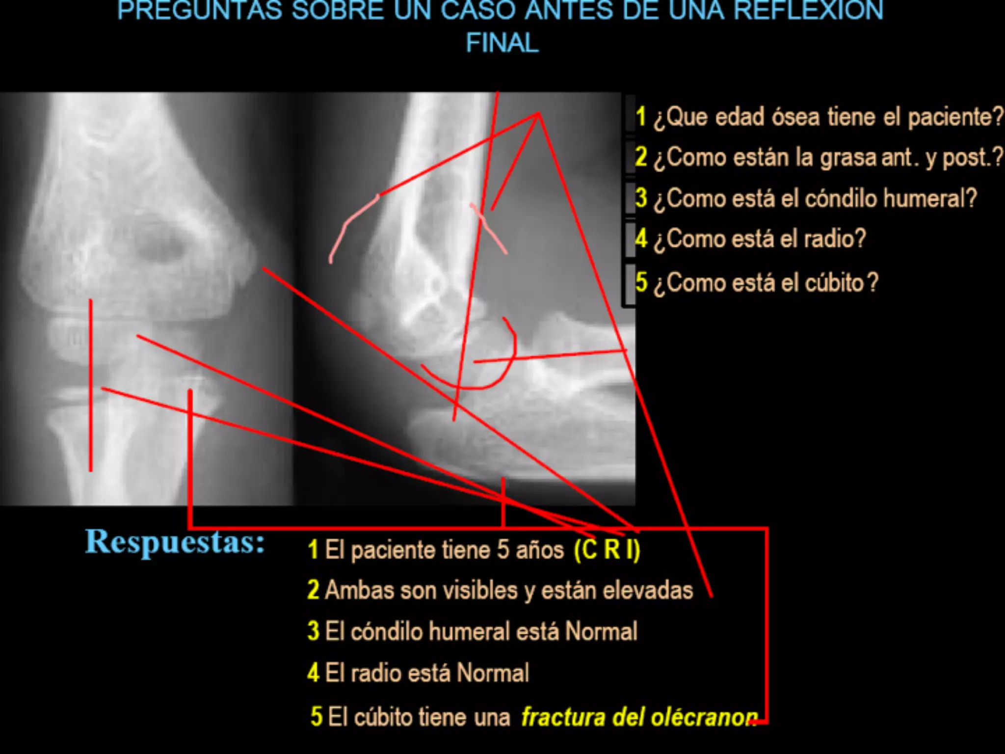 4 fx humero distal niños Dr Miguel Mite | PDF