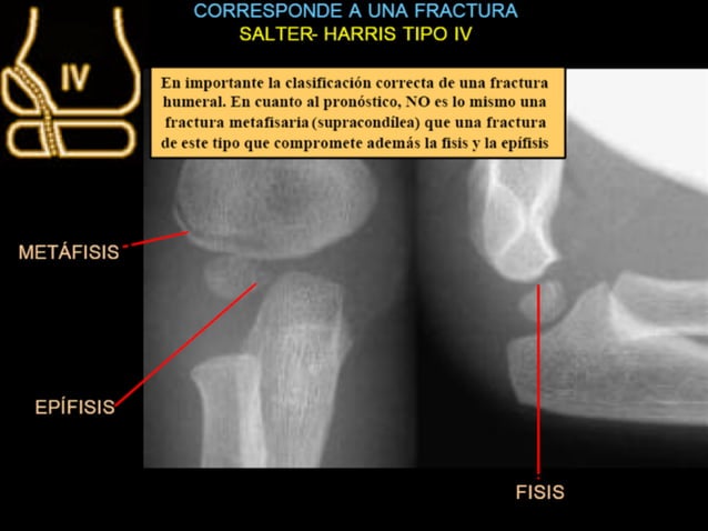 4 fx humero distal niños Dr Miguel Mite