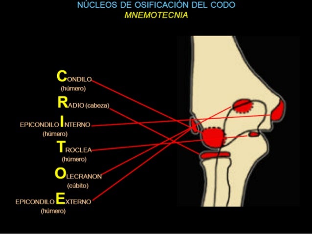 4 fx humero distal niños Dr Miguel Mite