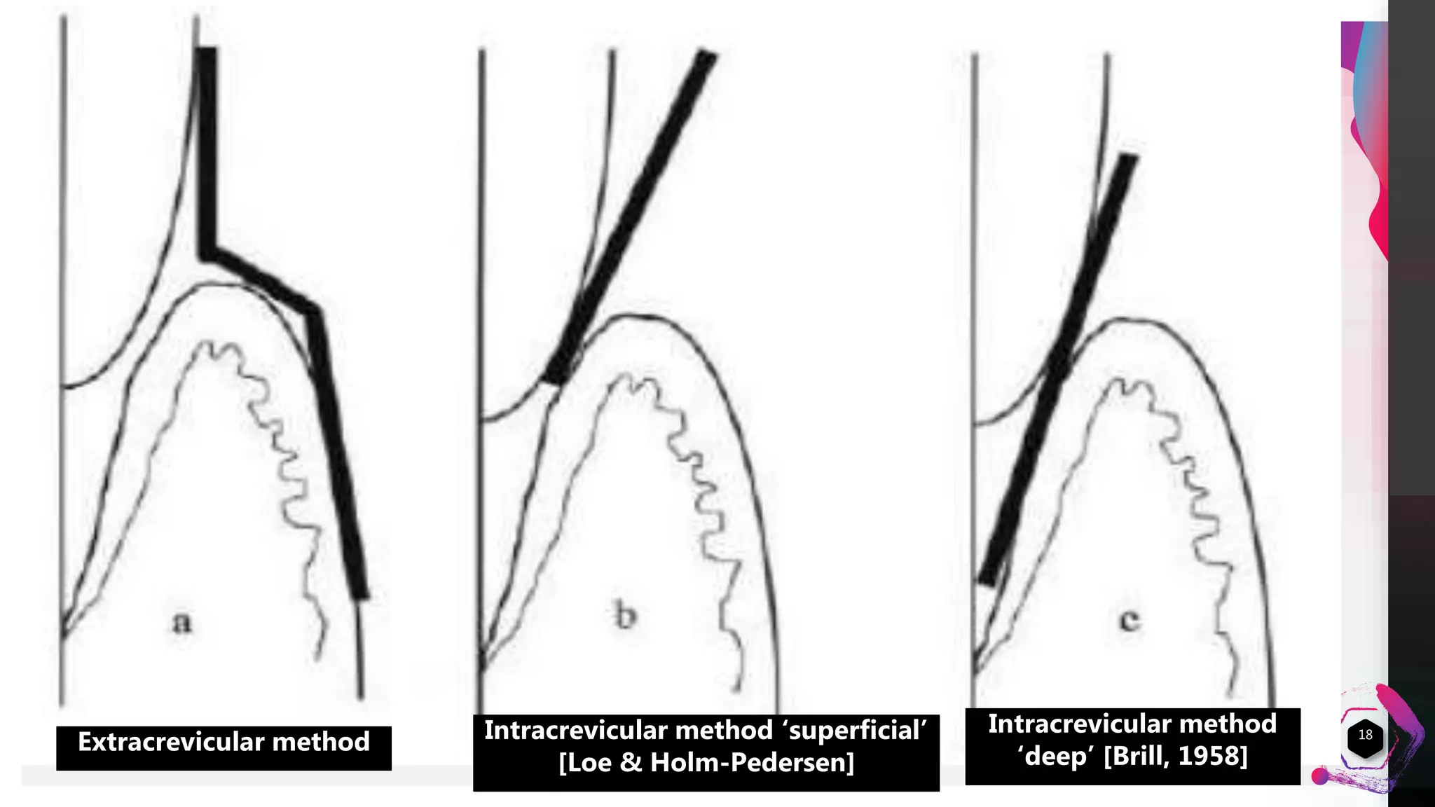 GINGIVAL CREVICULAR FLUID | PPTX