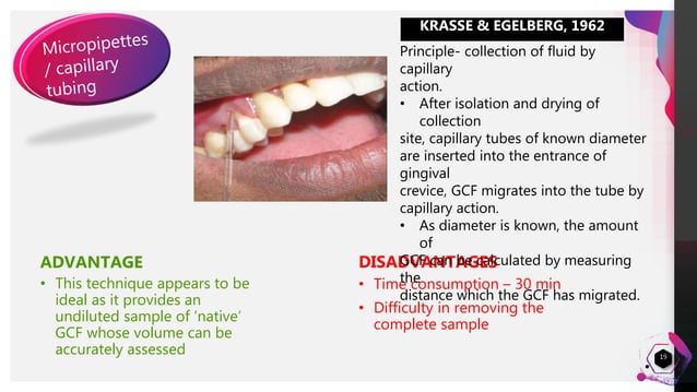 GINGIVAL CREVICULAR FLUID | PPTX | Biological Sciences | Science