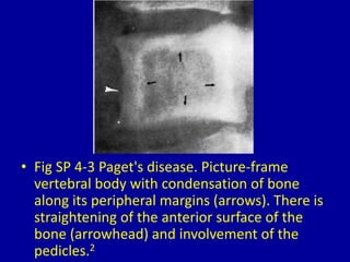 4 generalized vertebral otosclerosis | PPT