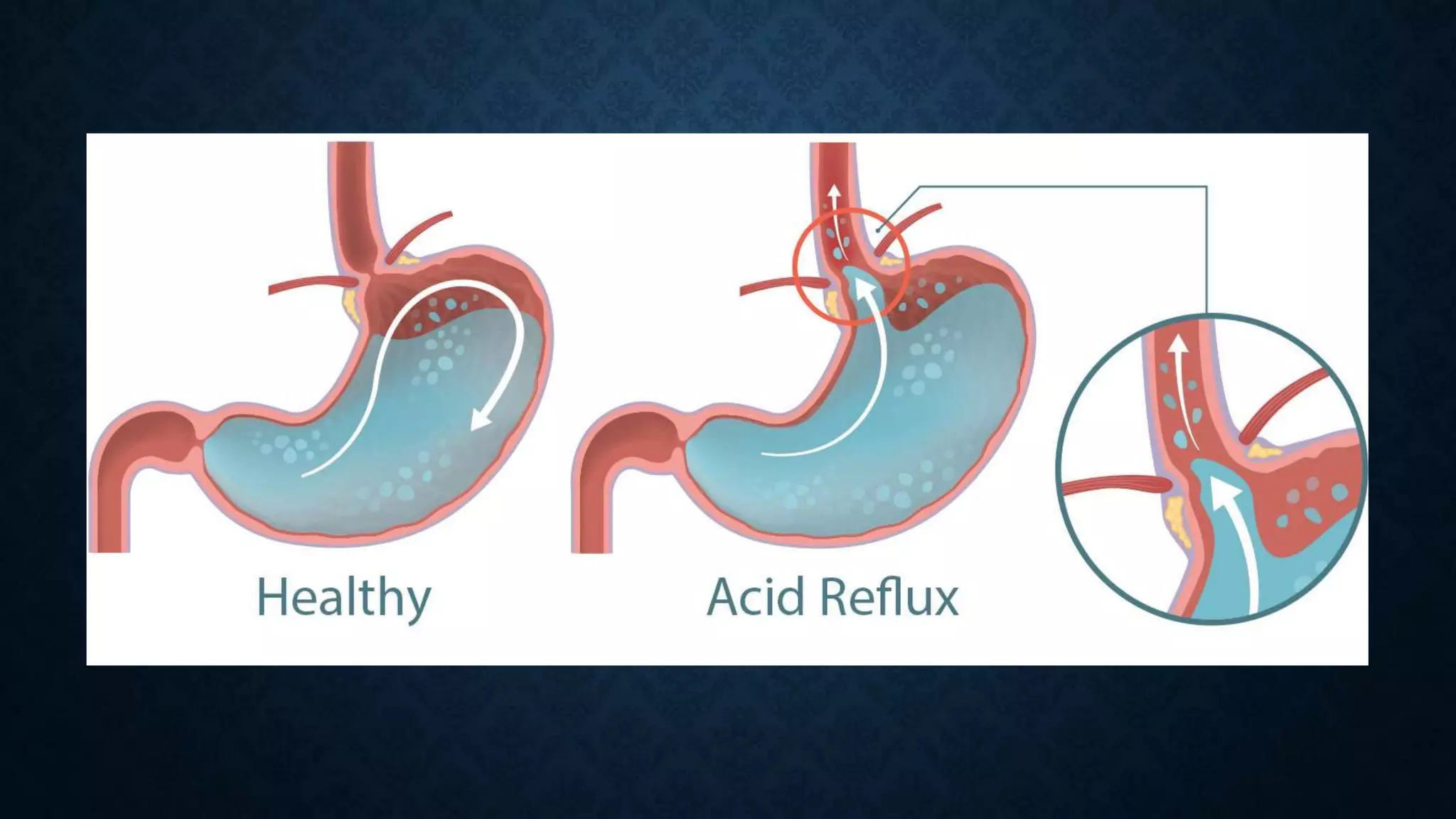 GASTROESOPHAGEAL REFLUX DISEASE | PPTX