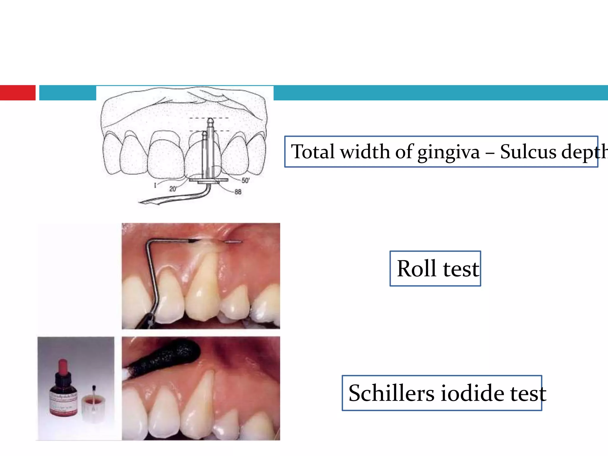 gingiva | PPTX