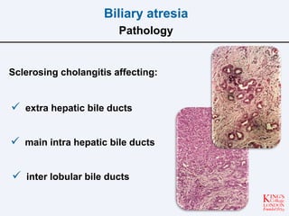 Long-term Outcome of Biliary Atresia and Liver Transplantation | PDF