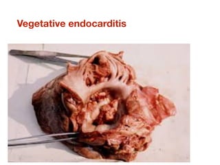 4 hydropericardium | PDF