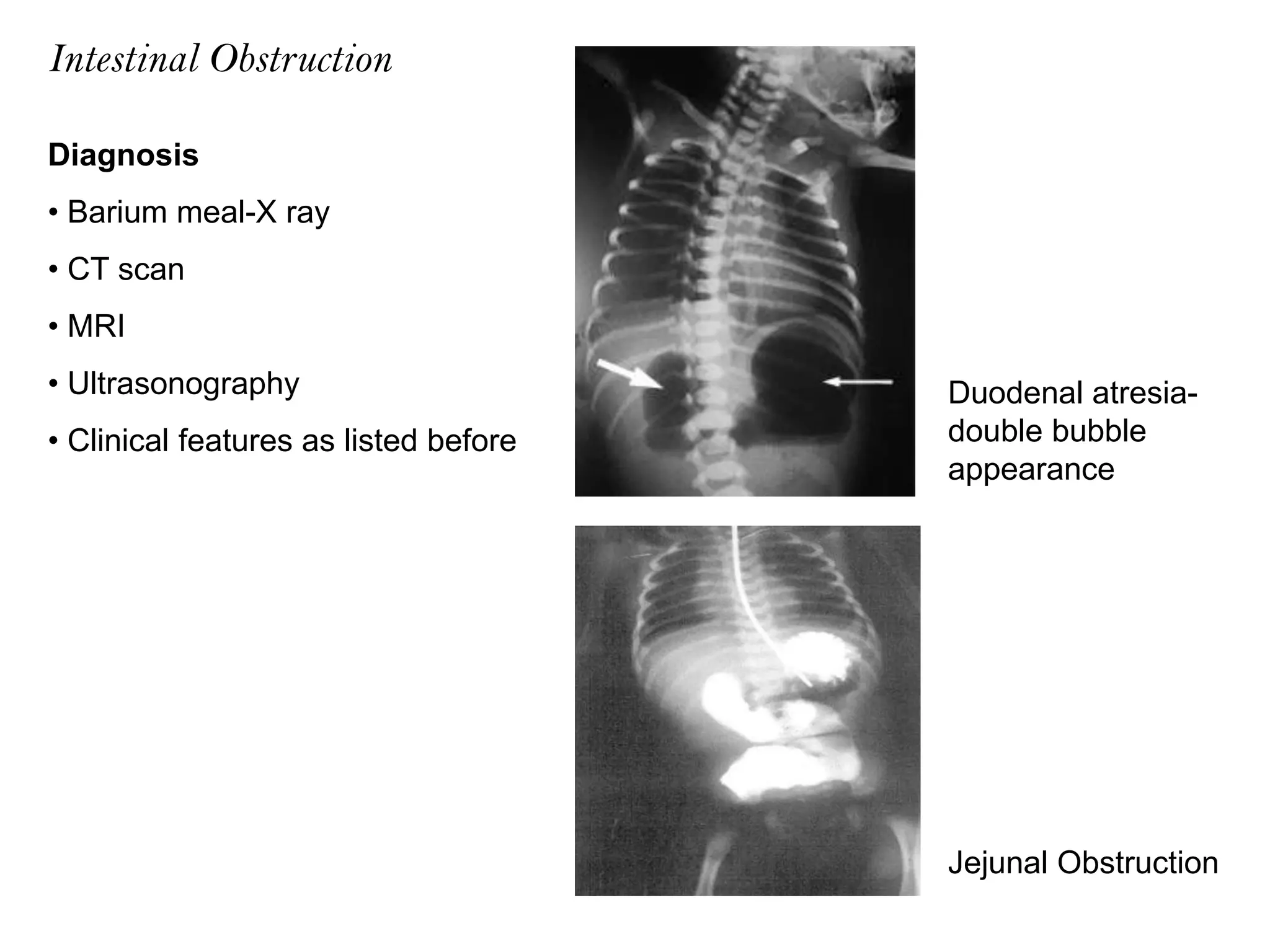 Intestinal Obstruction | PPTX