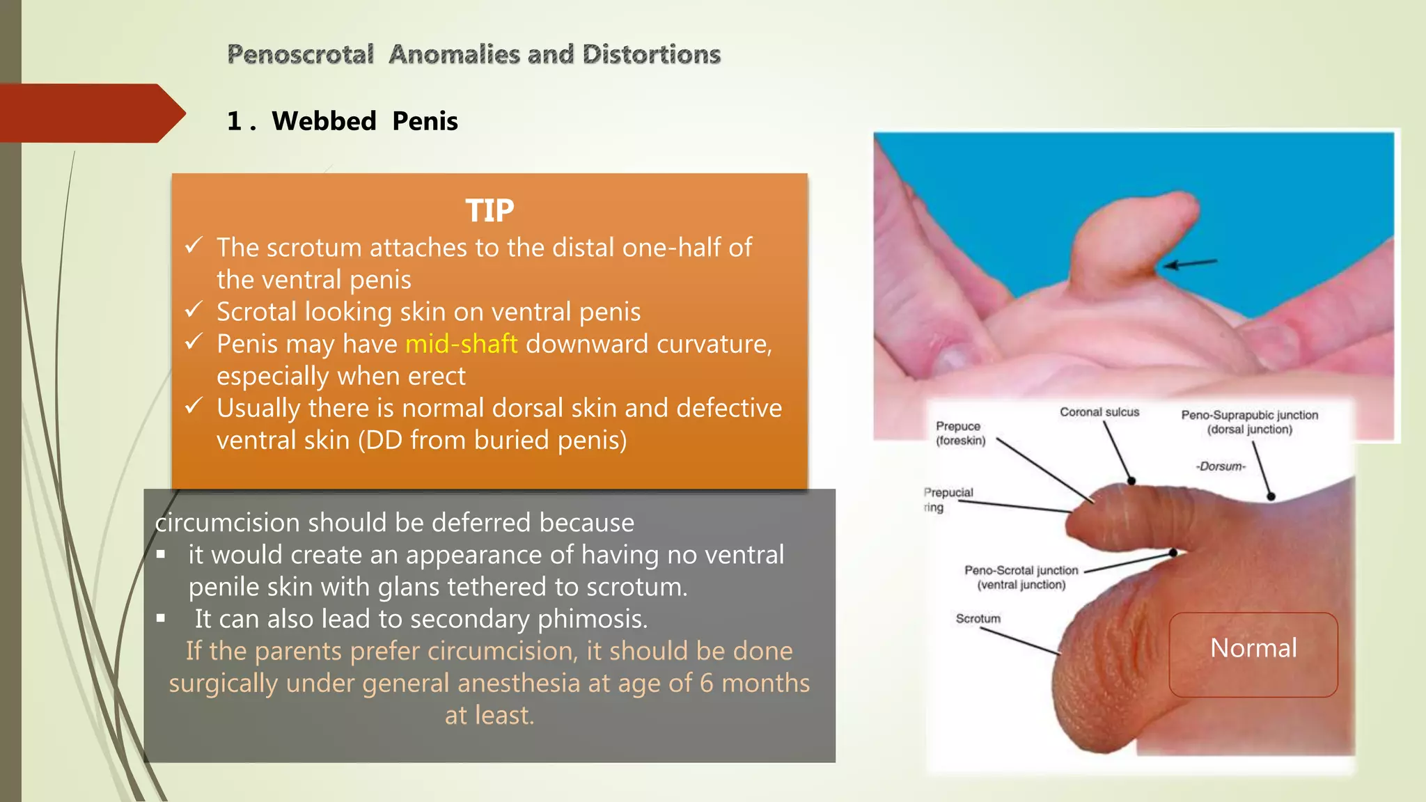 Pediatric Circumcision lecture | PPTX