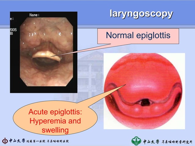 4 laryngeal disorders | PPT | Ear, Nose and Throat Conditions ...
