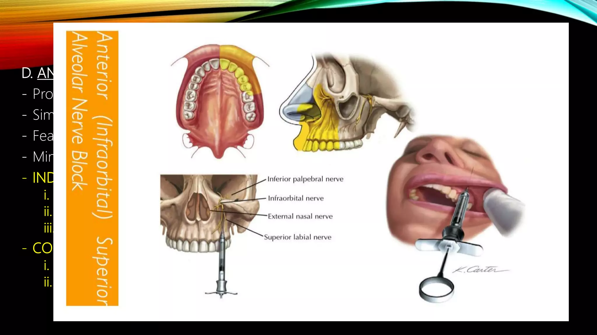 Local Anaesthesia in dentistry (Perio) | PPTX
