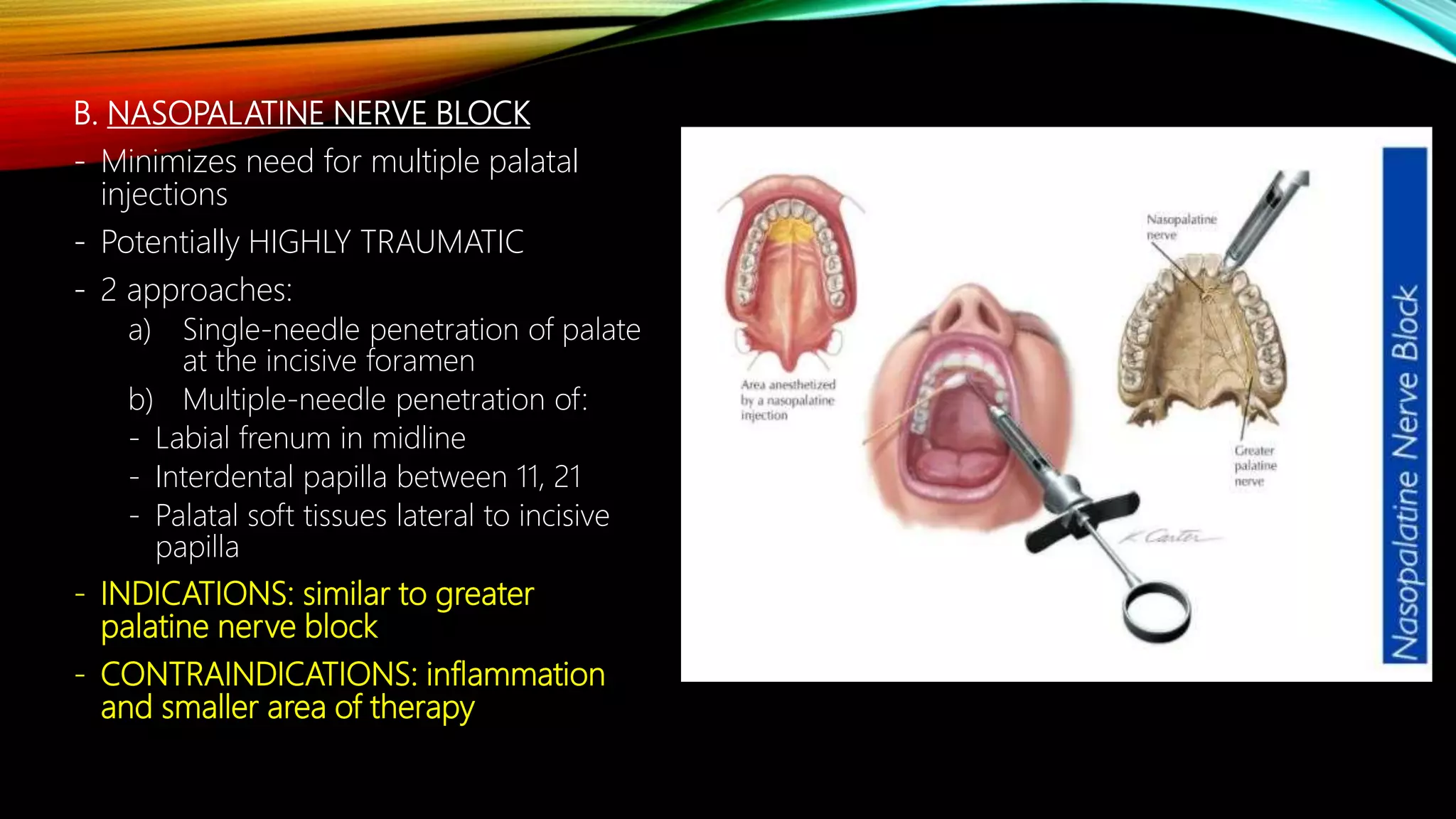 Local Anaesthesia in dentistry (Perio) | PPTX