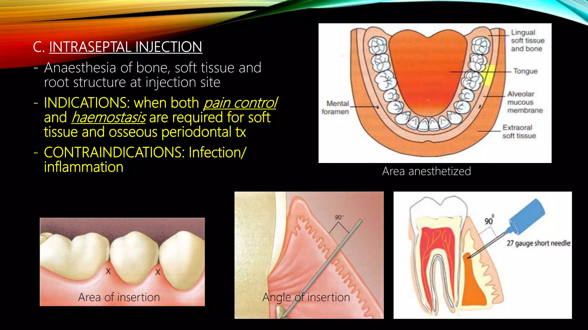 Local Anaesthesia in dentistry (Perio) | PPTX