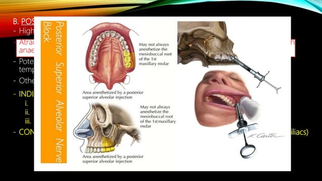 Local Anaesthesia in dentistry (Perio) | PPTX
