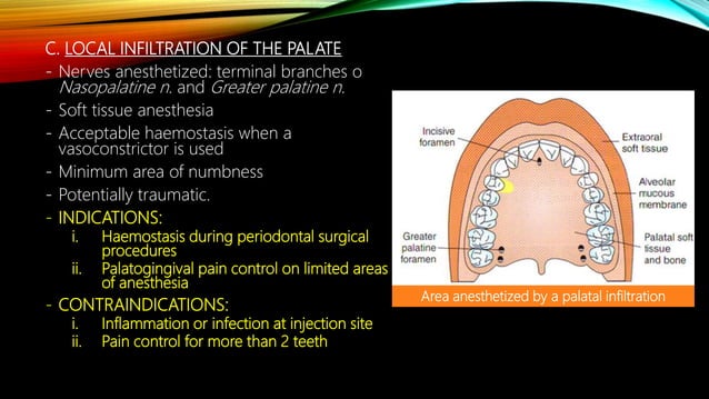Local Anaesthesia in dentistry (Perio) | PPTX