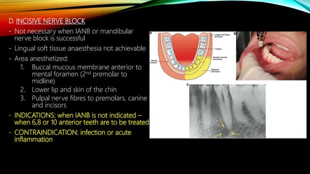 Local Anaesthesia in dentistry (Perio) | PPTX