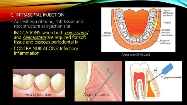 Local Anaesthesia in dentistry (Perio) | PPTX