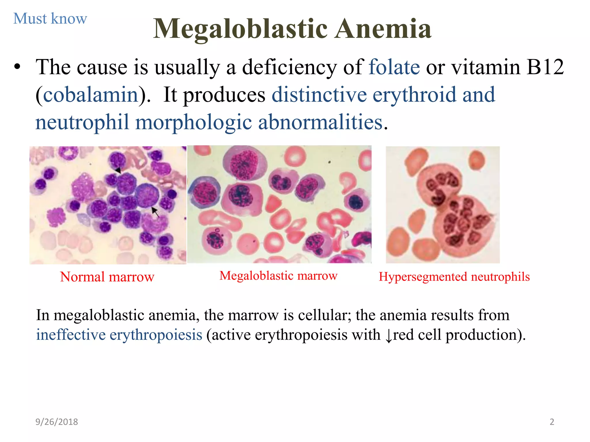 4 macrocytic anemia.ppt