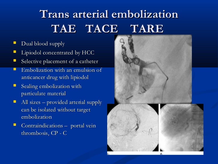 management of hepatocellular carcinoma