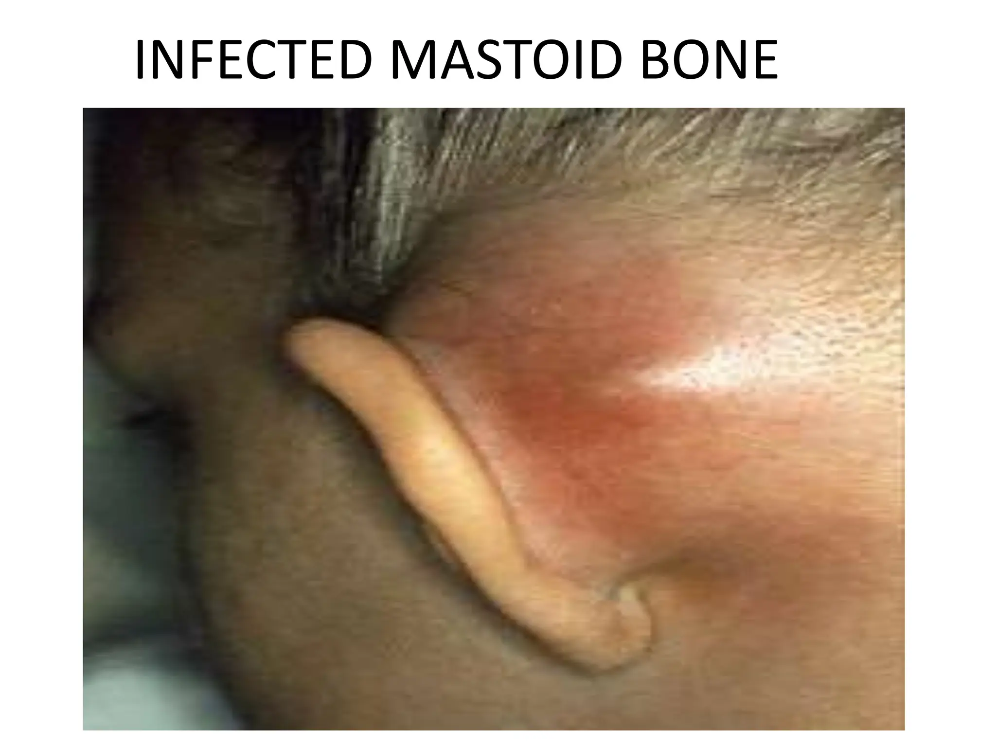MASTOIDITIS POWERPOINT WILL HELP YOU KNOW THE MAST SITE | PPT