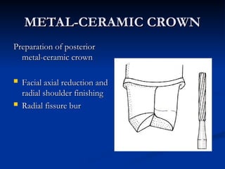 4_Metal-ceramic crownwwwwwwwwws-2021.ppt