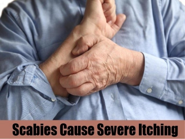 4 Most Common Scabies Symptoms