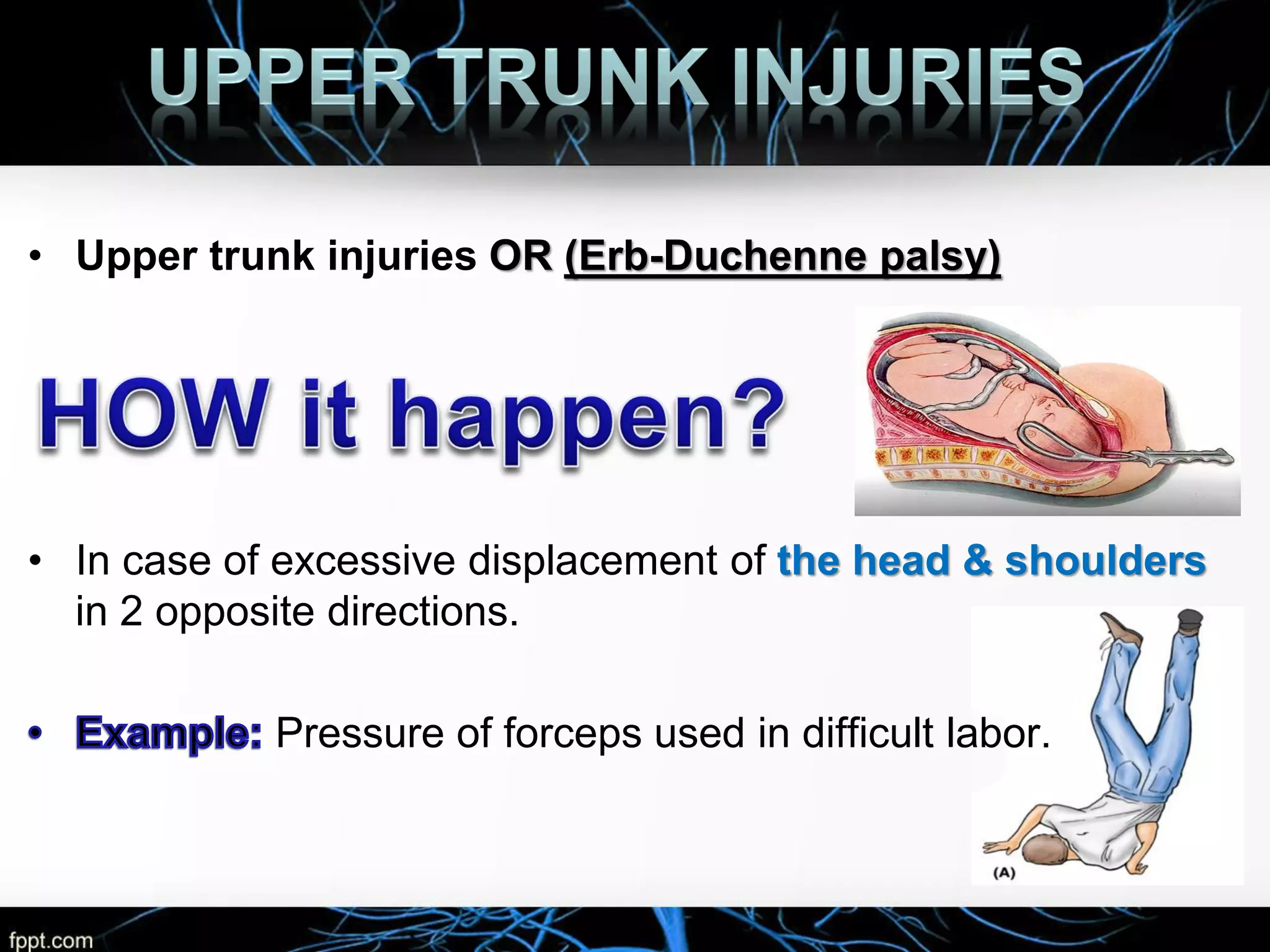 Brachial Plexus Injuries by rayan alhumaid | PDF