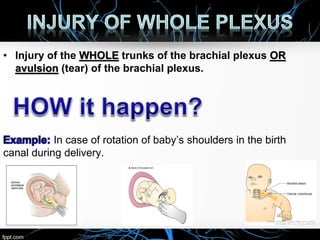 Brachial Plexus Injuries by rayan alhumaid | PPT