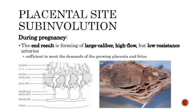4Nsic - Postpartum Hemorrhage