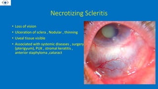 SCLERITIS presentation dhir hospital bhiwani.pptx