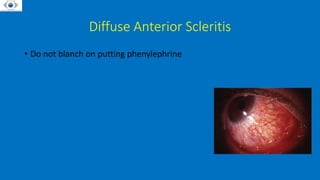 SCLERITIS presentation dhir hospital bhiwani.pptx