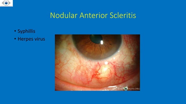 SCLERITIS presentation dhir hospital bhiwani.pptx