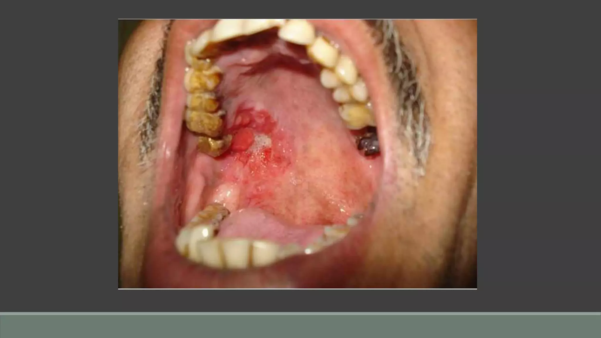 Oral Red Lesions pdf | PDF