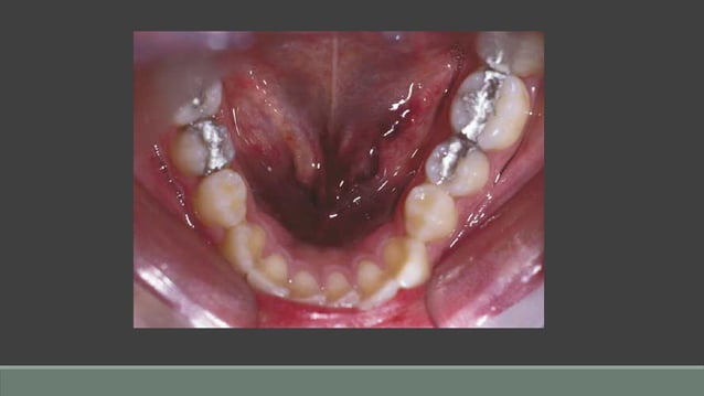 Oral Red Lesions pdf | PPT