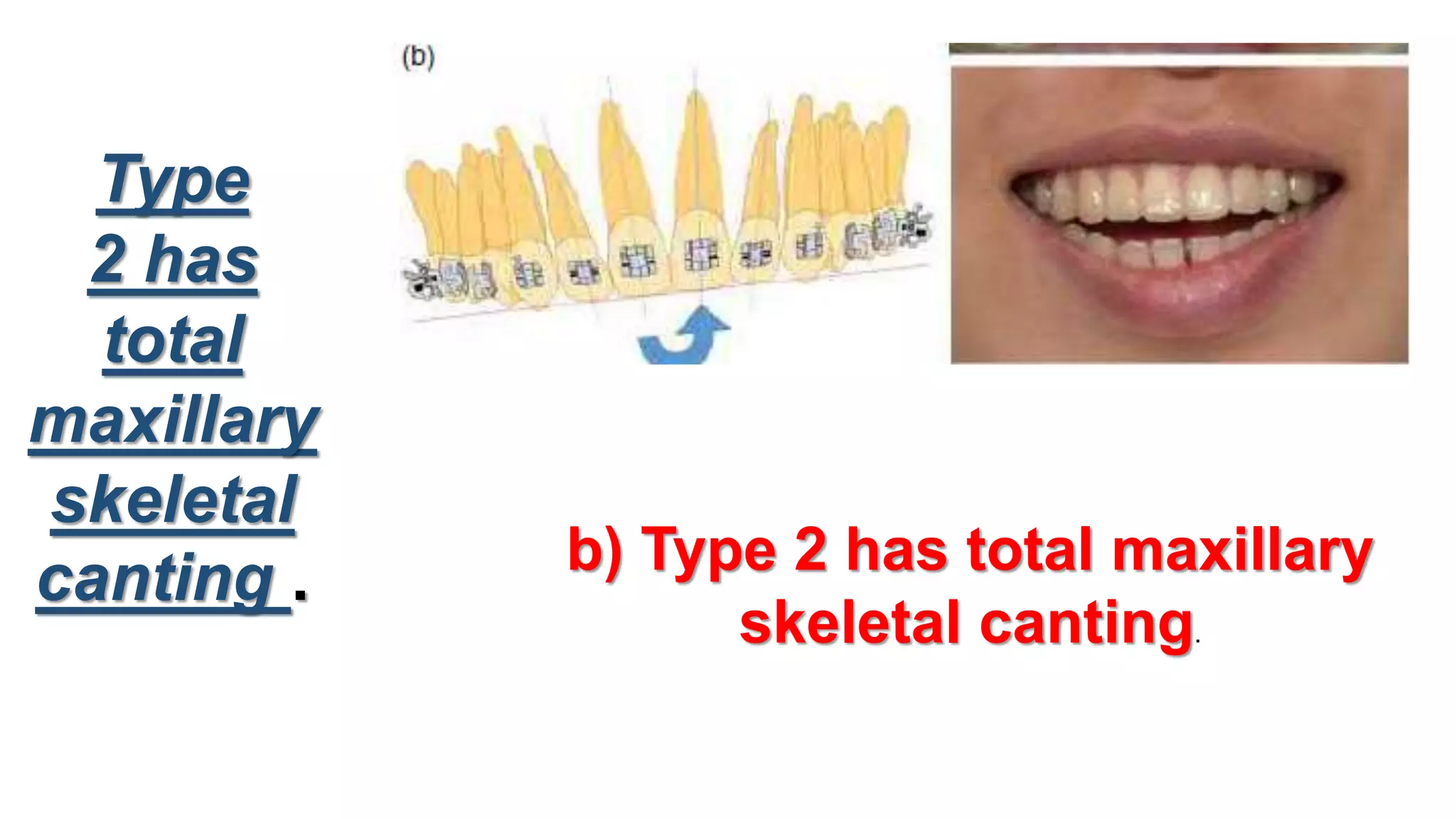 orthodontic correction of canted occlusal plane part 4 | PPTX