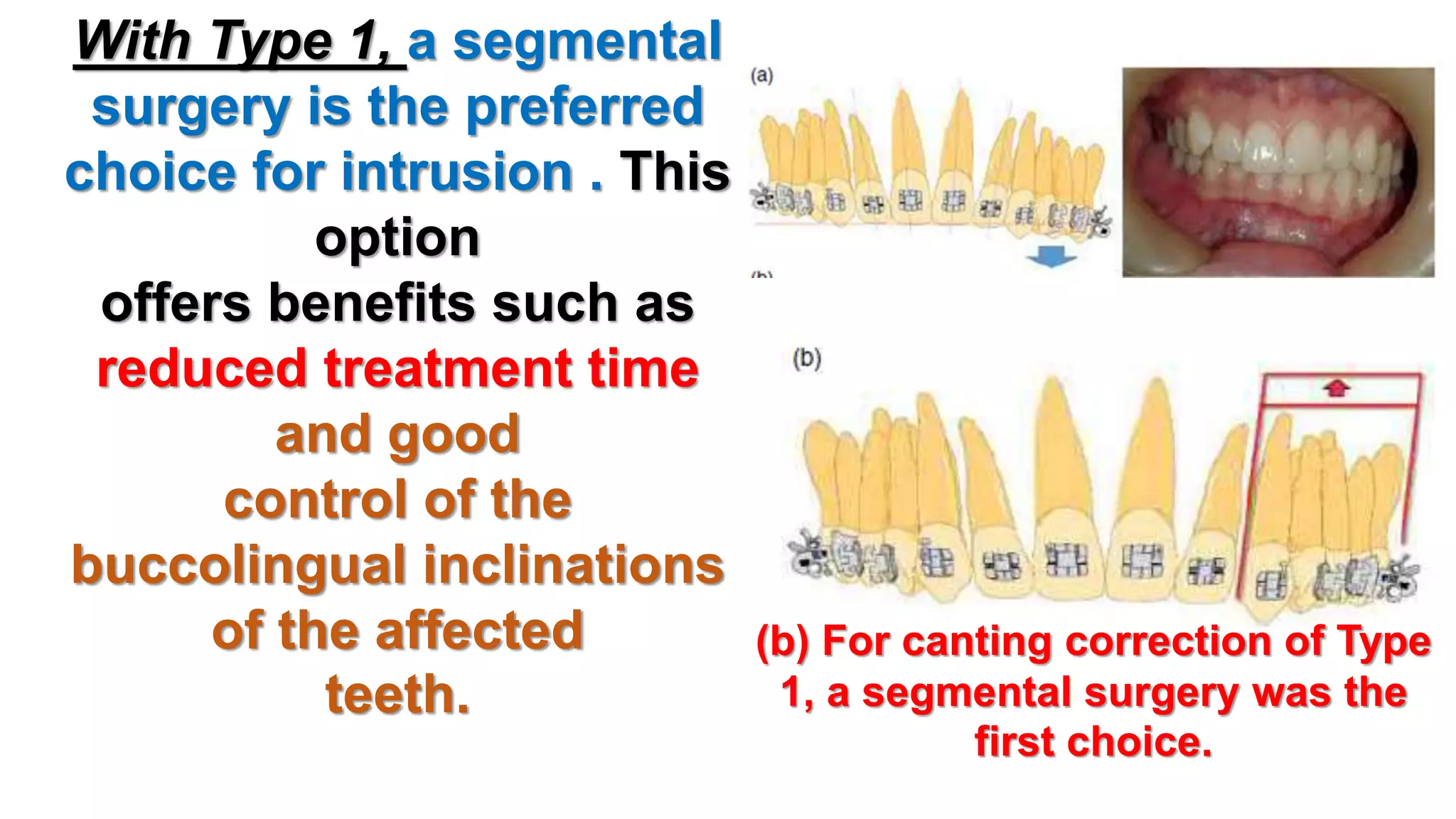 orthodontic correction of canted occlusal plane part 4 | PPTX