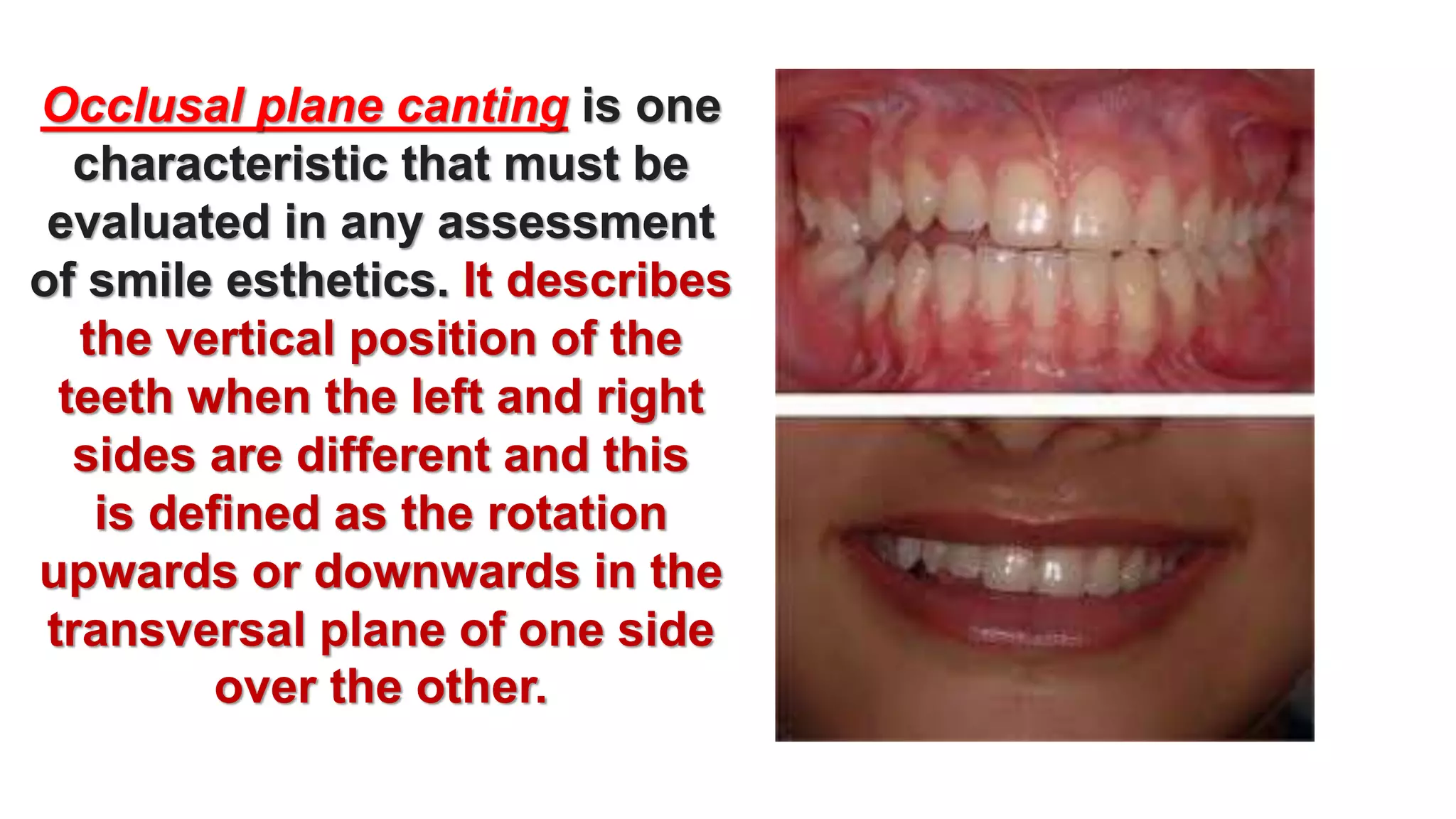 orthodontic correction of canted occlusal plane part 4 | PPTX