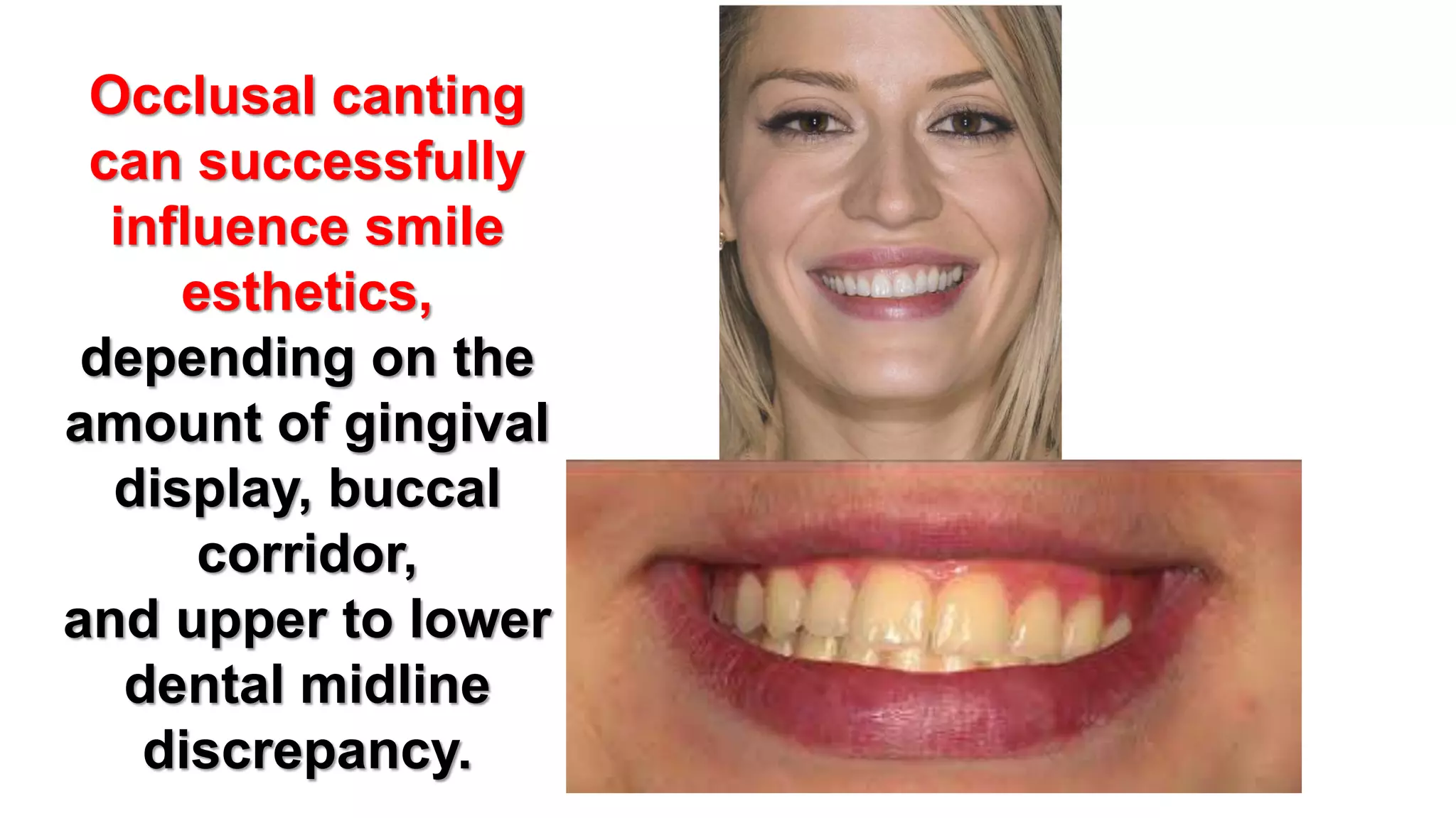 orthodontic correction of canted occlusal plane part 4 | PPTX