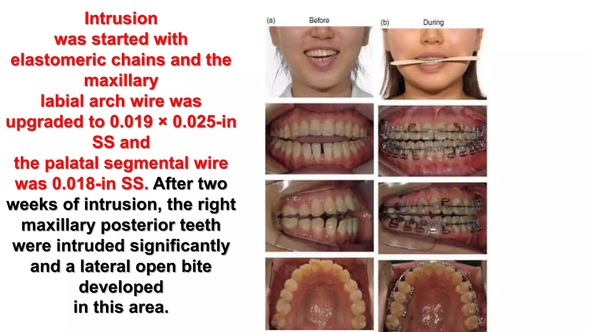 orthodontic correction of canted occlusal plane part 4 | PPTX